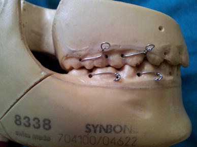 A New Simplified Technique for Intermaxillary Fixation by Loop-Designed ...