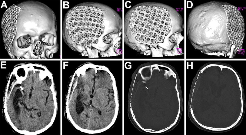 Efficacy and Versatility of the 3-D Titanium Mesh Implant in the ...