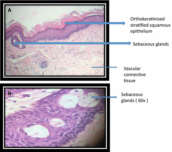 Simultaneous Occurrence of a Midline Sublingual Dermoid Cyst with ...