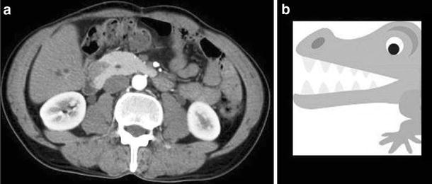 Crocodile-jaw pancreas | SpringerLink