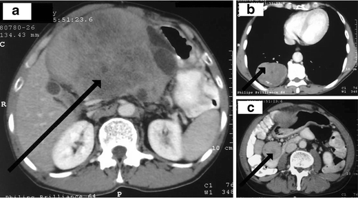 Carney’s triad | SpringerLink