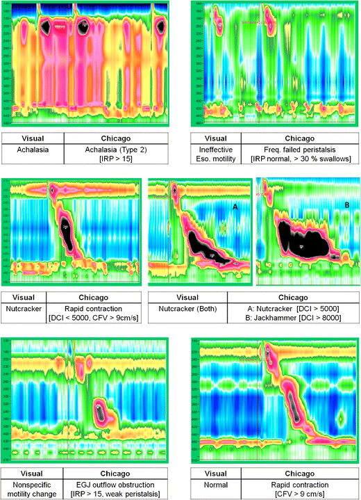 High resolution esophageal manometry—The switch from “intuitive” visual ...