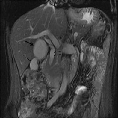 Ciliated hepatic foregut cyst | SpringerLink