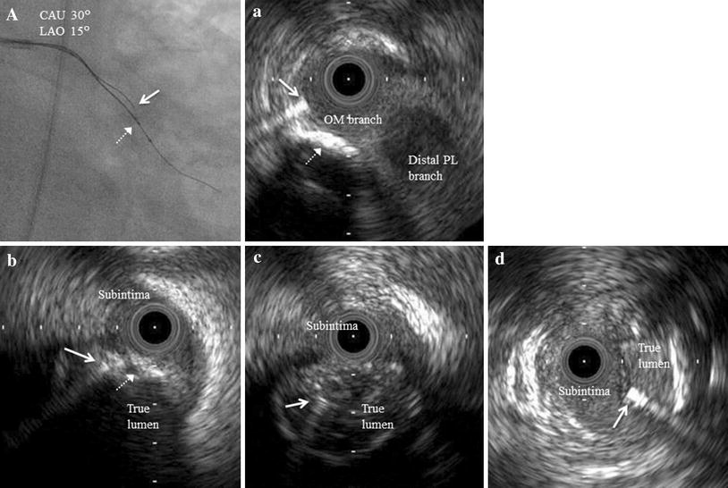 Navifocus WR is the promising intravascular ultrasound for navigating ...