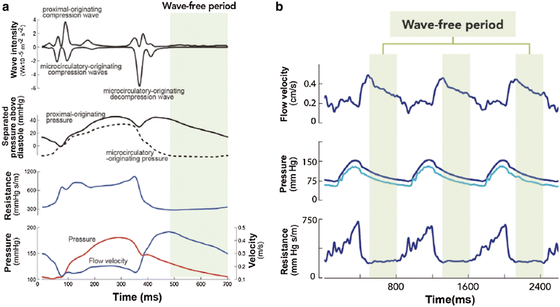 FFR and iFR guided percutaneous coronary intervention | SpringerLink