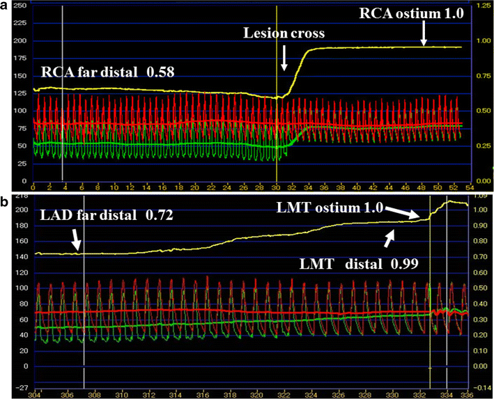 FFR and iFR guided percutaneous coronary intervention | SpringerLink