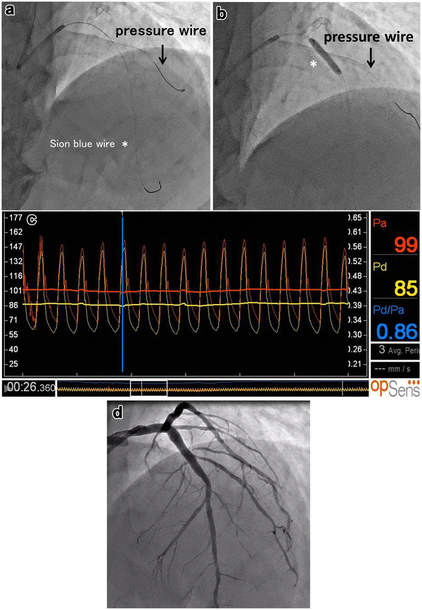 The utility of a jailed pressure wire technique for the treatment of ...