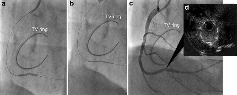 Right coronary artery stenosis associated with tricuspid valve ring ...