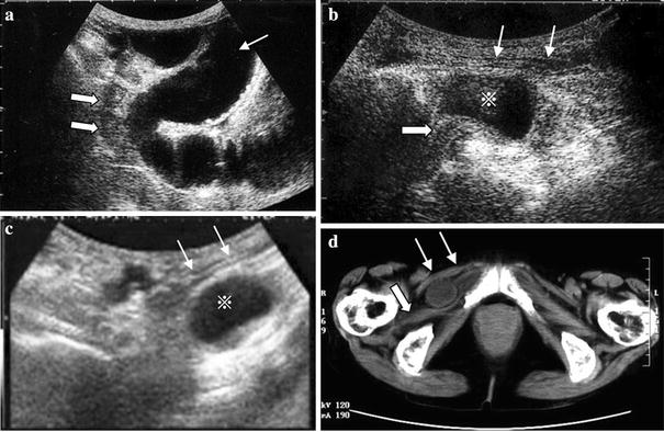 Incarcerated obturator hernia: pitfalls in the application of ...