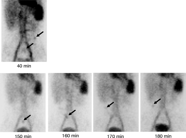 99mTc-Labeled RBC Scan in a Patient with Blue Rubber Bleb Nevus ...