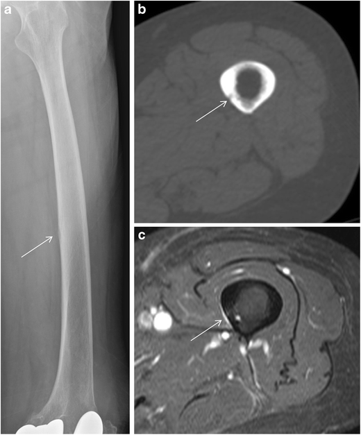 Focal Increased Tc-99m MDP Uptake in the Nutrient Foramen of the ...