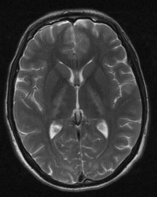 “Chasing the Dragon”—Heroin-Associated Spongiform Leukoencephalopathy ...