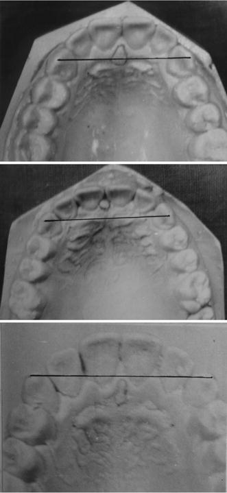 The Incisive Papilla: A Significant Landmark in Prosthodontics ...