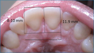 The Incisive Papilla: A Significant Landmark in Prosthodontics ...