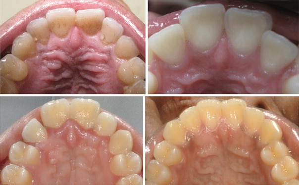 The Incisive Papilla: A Significant Landmark in Prosthodontics ...
