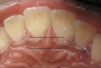 The Incisive Papilla: A Significant Landmark in Prosthodontics ...