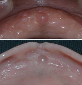 The Incisive Papilla: A Significant Landmark in Prosthodontics ...