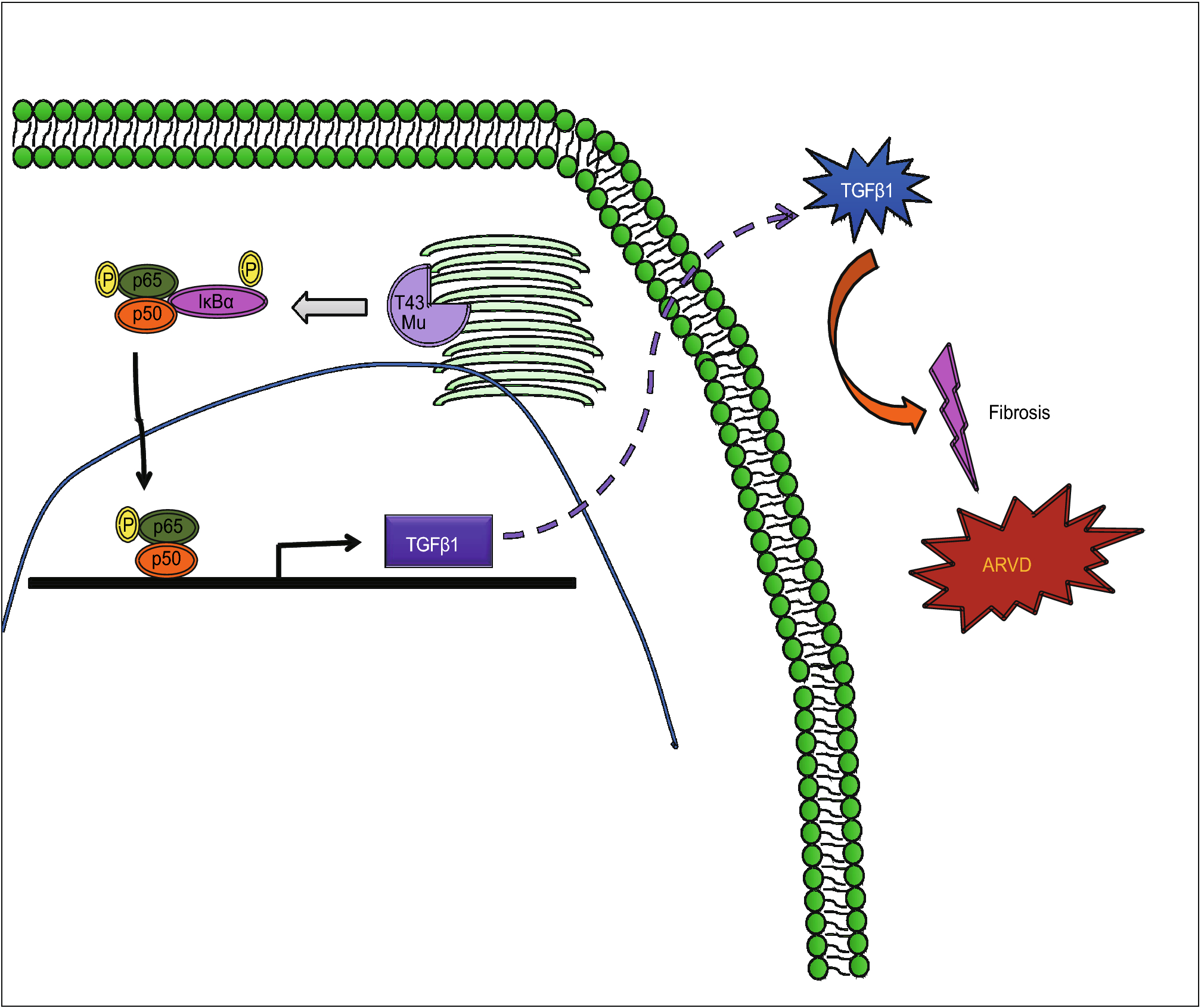 TMEM43-S358L mutation enhances NF-κB-TGFβ signal cascade in ...