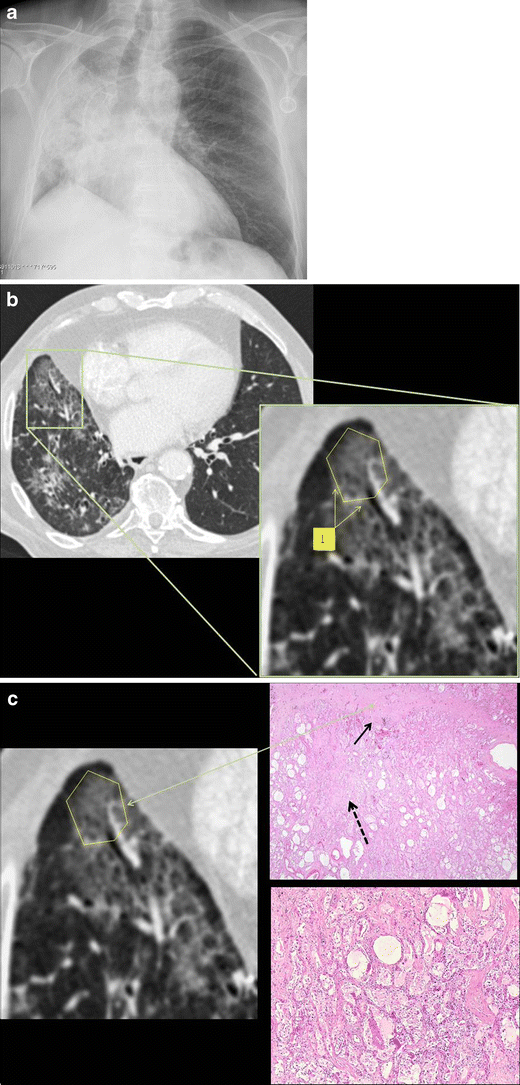 The crazy-paving pattern: a radiological-pathological correlation ...
