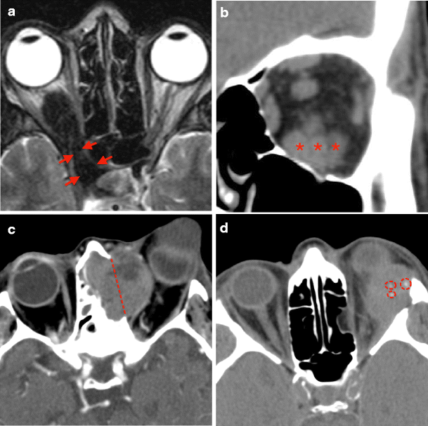 Orbital lymphoma: imaging features and differential diagnosis ...