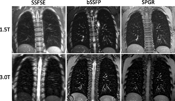 MRI of the lung (1/3): methods | SpringerLink