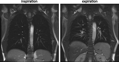 MRI of the lung (1/3): methods | SpringerLink