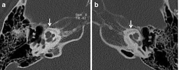 Imaging in otosclerosis: A pictorial review | SpringerLink