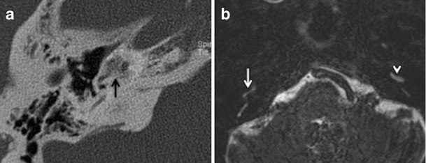 Imaging in otosclerosis: A pictorial review | SpringerLink