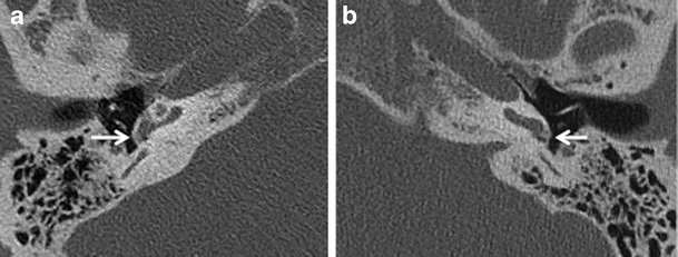 Imaging in otosclerosis: A pictorial review | SpringerLink
