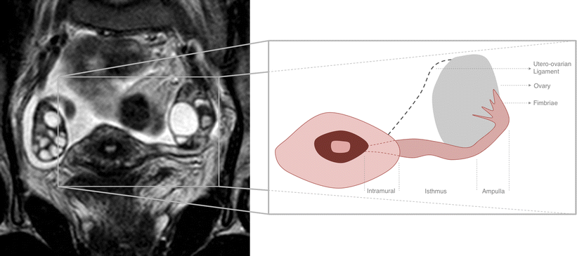 Primary fallopian tube carcinoma: review of MR imaging findings ...