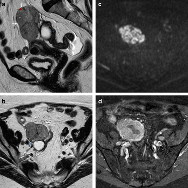 Primary fallopian tube carcinoma: review of MR imaging findings ...