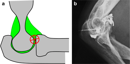 A practical guide for performing arthrography under fluoroscopic or ...