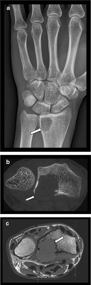Cone beam CT of the musculoskeletal system: clinical applications ...