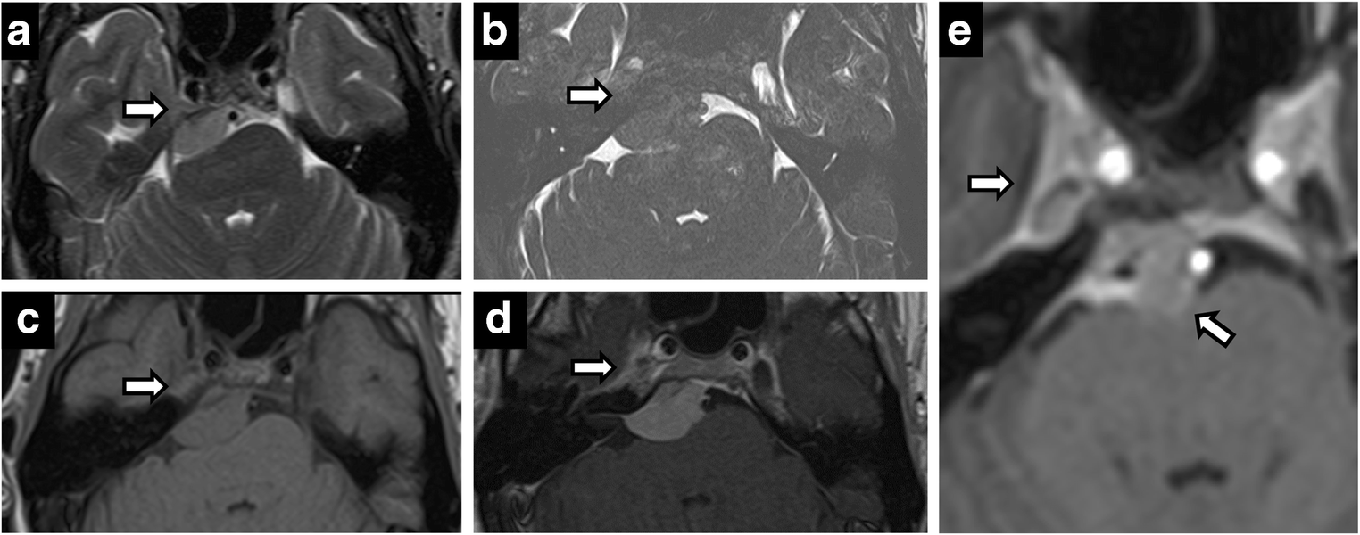 Neuroimaging of Meckel’s cave in normal and disease conditions ...
