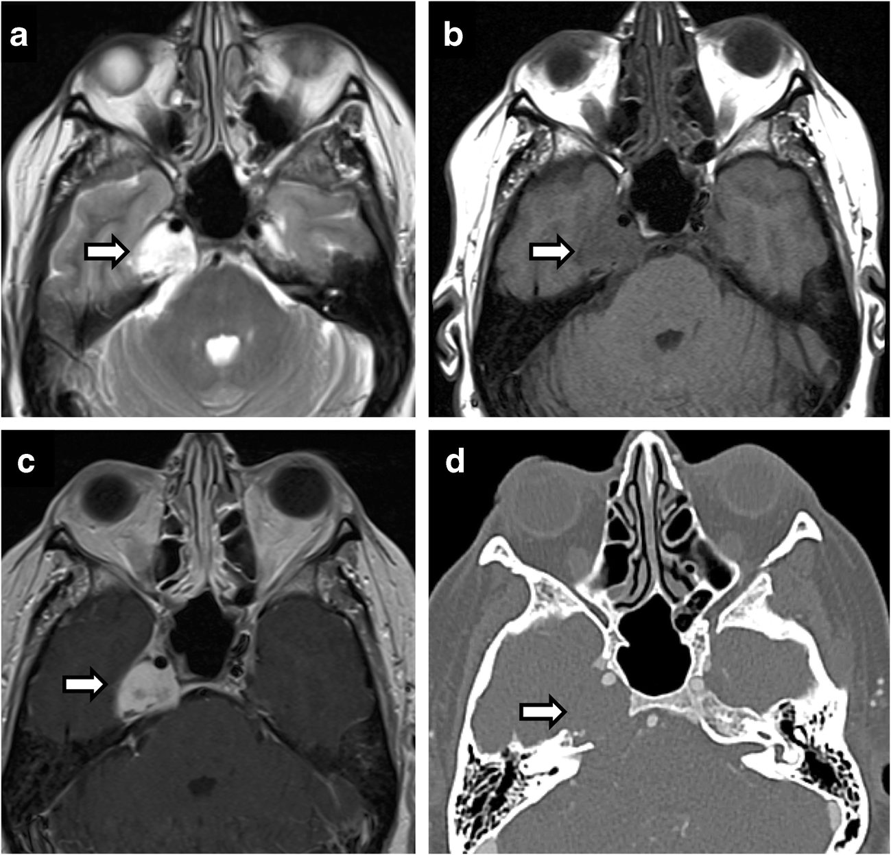 Neuroimaging of Meckel’s cave in normal and disease conditions ...