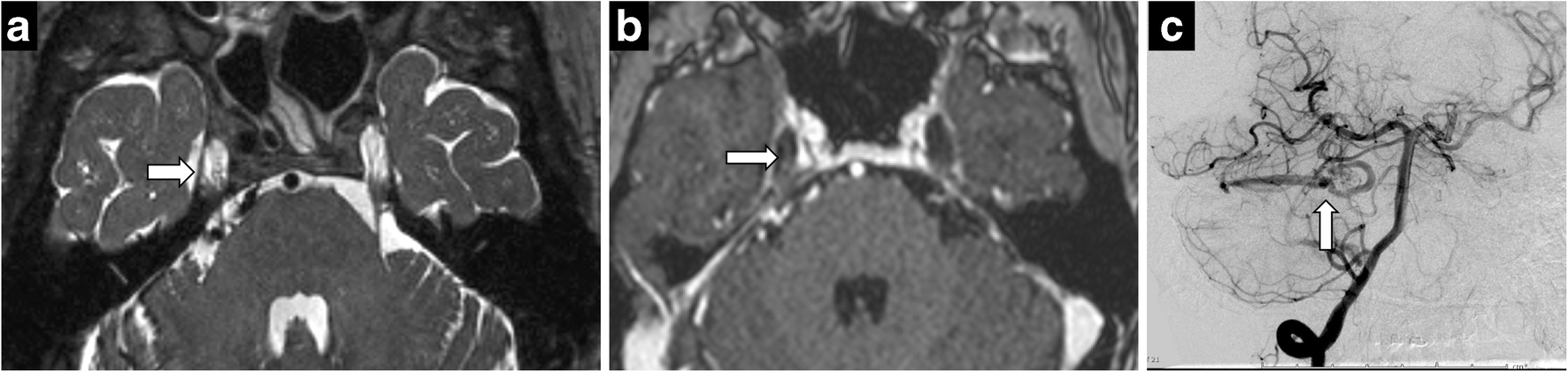 Neuroimaging of Meckel’s cave in normal and disease conditions ...