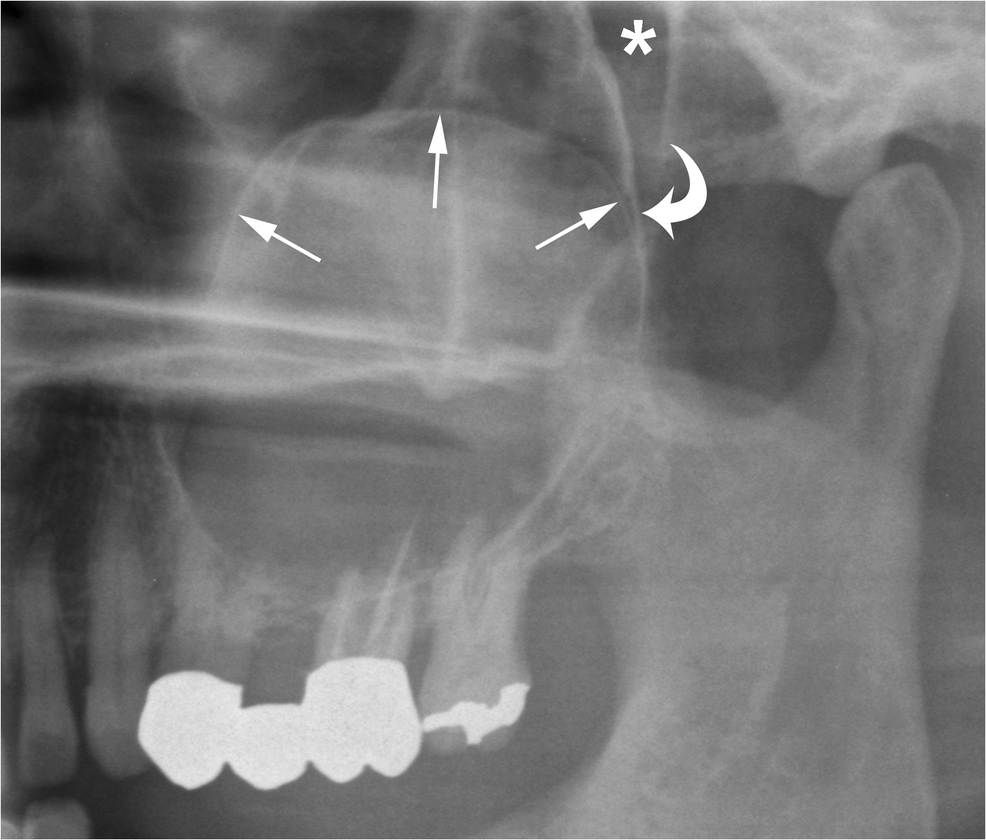 Odontogenic keratocyst: imaging features of a benign lesion with an ...