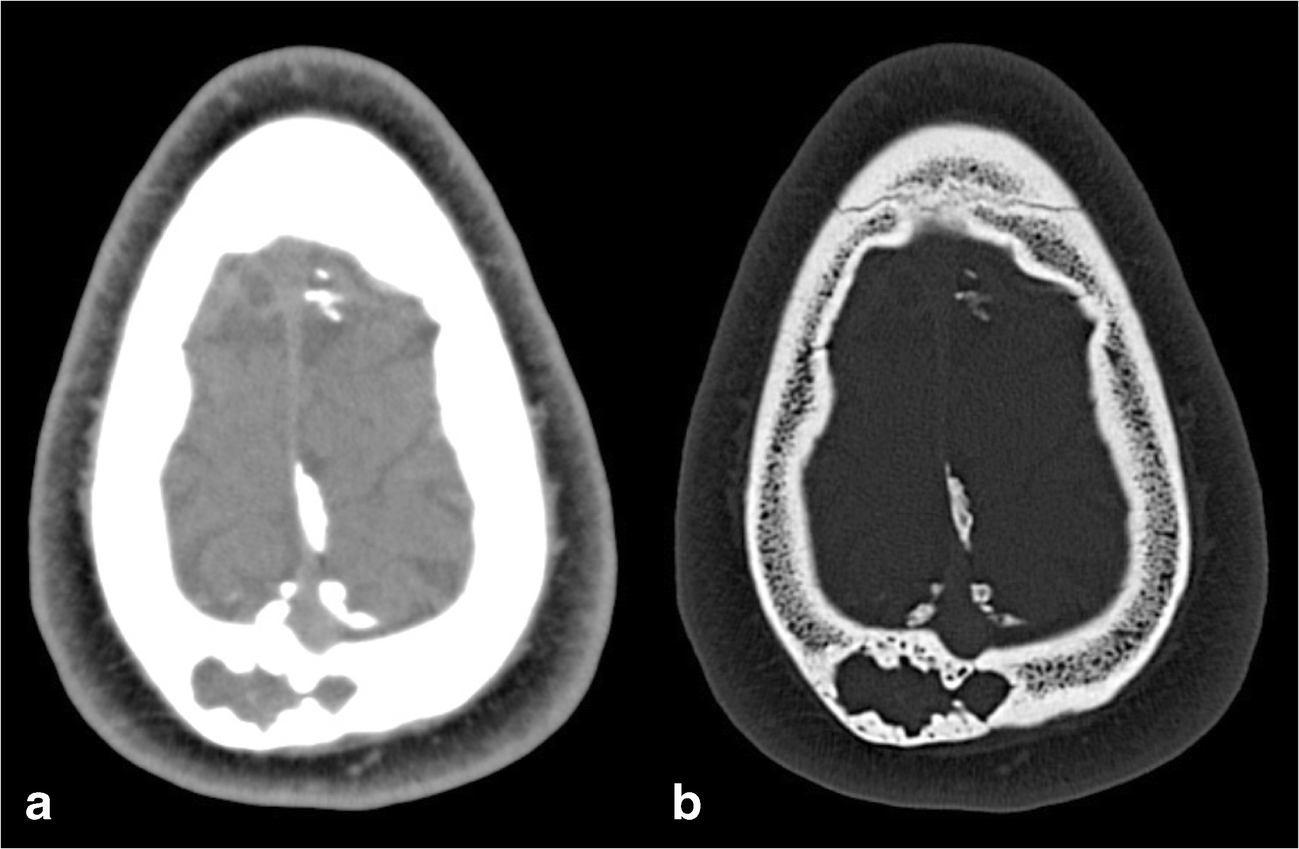 Spectrum of lytic lesions of the skull: a pictorial essay | SpringerLink