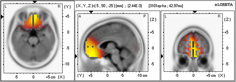 EEG based brain source localization comparison of sLORETA and eLORETA ...
