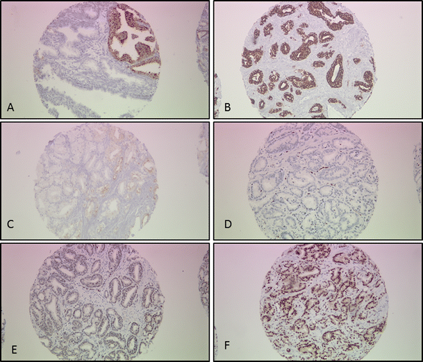 High alpha-methylacyl-CoA racemase (AMACR) is associated with ERG ...