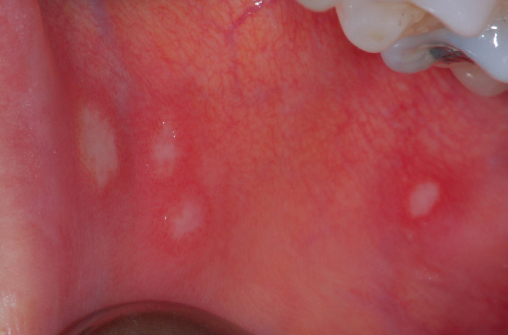 Erkrankungen der Mundschleimhaut | SpringerLink