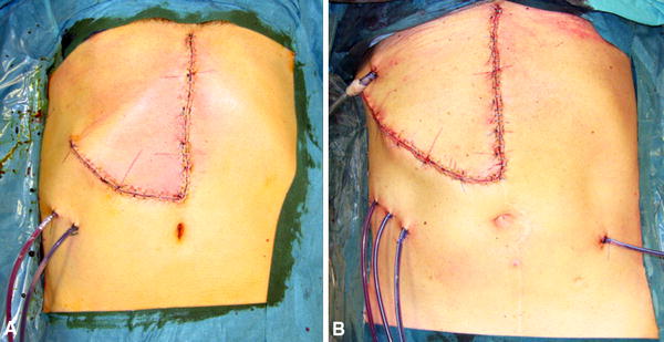 Thoracoabdominal approach in liver surgery: how, when, and why ...