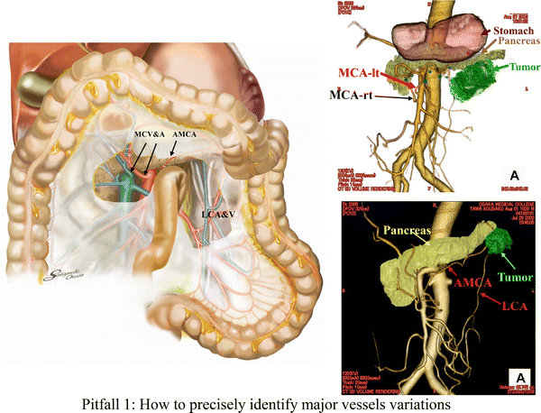 Laparoscopic resection of transverse colon cancer at splenic flexure: technical aspects and ...