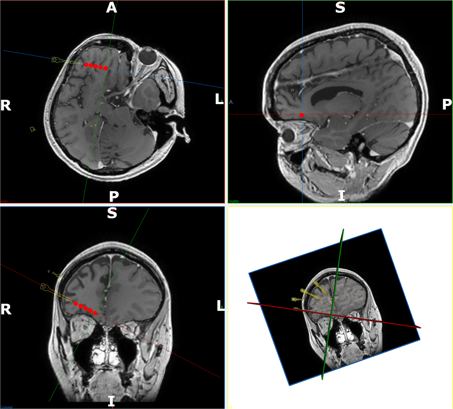 Computer-Assisted Planning for Stereoelectroencephalography (SEEG ...