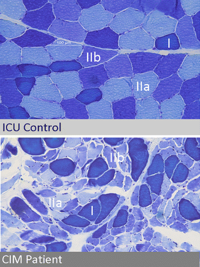 Intensive care unit—acquired weakness (ICUAW) and muscle wasting in ...