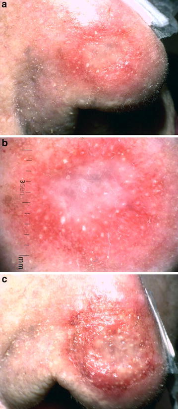 Imiquimod 5% as Adjuvant Therapy for Incompletely Excised Infiltrative ...