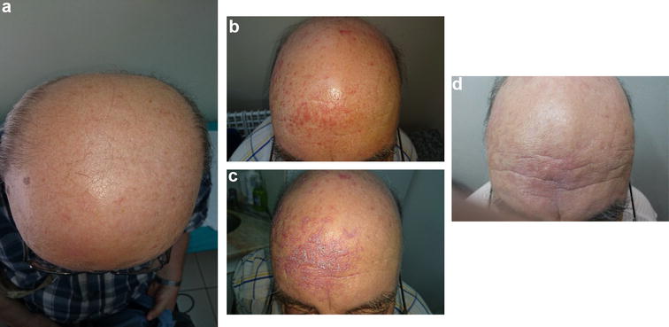 Daylight Photodynamic Therapy Versus 5-Fluorouracil for the Treatment ...