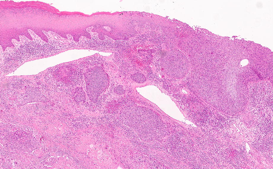 Squamous Cell Carcinomas in Two Cases of Nail Lichen Planus: Is There a ...