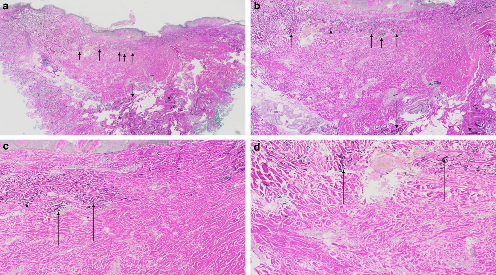 Atrophic Dermatofibroma: A Comprehensive Literature Review | SpringerLink