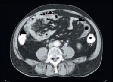 Robotgeassisteerde laparoscopische ureterolyse met een omental wrap bij ...